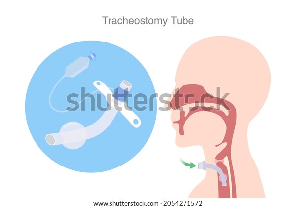 Tracheostomy Tube Trach Tube Device Help Stock Vector (Royalty Free ...