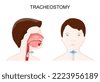 Tracheostomy Royalty-Free Images, Stock Photos & Pictures | Shutterstock