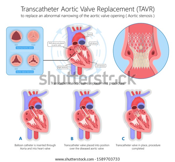 Transcatheter Aortic Valve Replacement Implantation Tavr 库存矢量图（免版税 ...