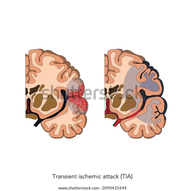 Transient Ischemic Attack Tia Vektor Stock Vector (Royalty Free ...