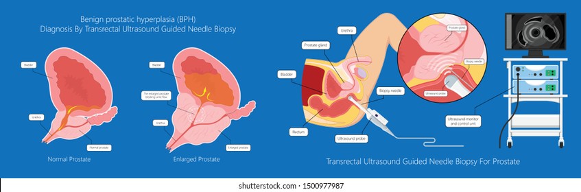 Transurethral Resection Prostate Stricture Urine Bladder 스톡 벡터(로열티 프리 ...