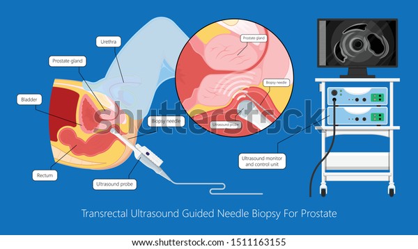 Transurethral Resection Prostate Stricture Urine Bladder Stock Vector