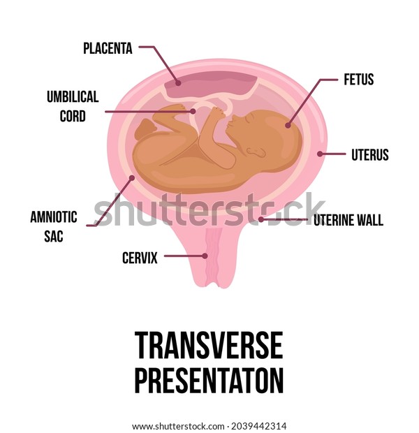 가로 방향 아기 프레젠테이션 다이어그램임신 중에 스톡 벡터(로열티 프리) 2039442314 | Shutterstock