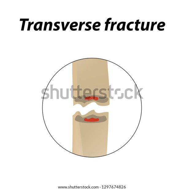 Transverse Bone Fracture Infographics Vector Illustration : image ...
