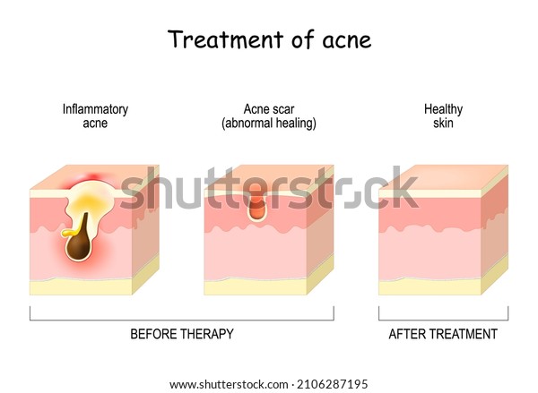 Treatment Acne Skin Layers Before After Stock Vector (Royalty Free ...