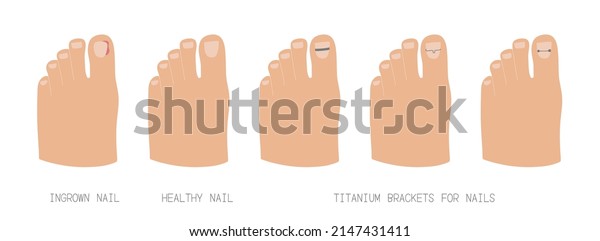 Treatment Ingrown Toenail Titanium Brackets Different 库存矢量图（免版税 ...