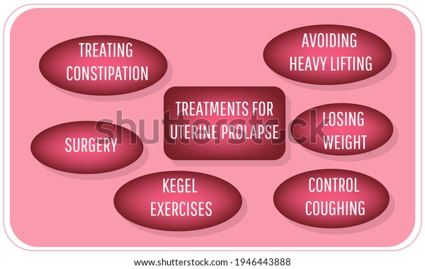 Treatments Uterine Prolapse Vector Illustration Medical Stock Vector