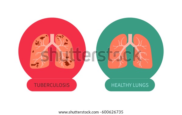 Tuberculosis Versus Healthy Lungs Symbol Tb Stock Vector (Royalty Free ...