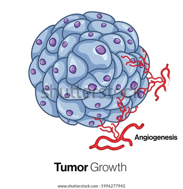 Tumor Growth Illustration Angiogenesis Stock Vector (Royalty Free ... Tumor Growth Illustration Angiogenesis Stock Vector (Royalty Free ...