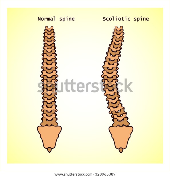 Two Types Spine Normal Twisted Scoliosis Stock Vector (Royalty Free ...