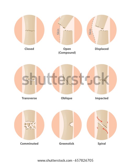 Type Fracture Circle Illustration Vector On Stock Vector (Royalty Free ...