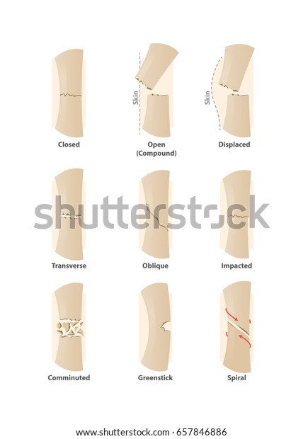 Type Fracture Illustration Vector On White Stock Vector (Royalty Free ...