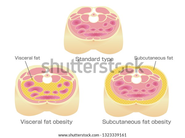 Type Obesity Illustration Abdominal Sectional View Stock Vector ...