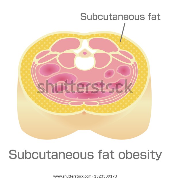 Type Obesity Illustration Abdominal Sectional View Stock Vector ...