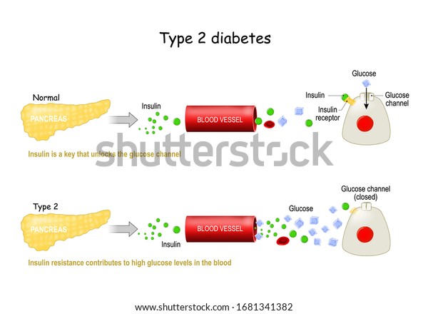 Types 2 Diabetes Mellitus Comparison Cell Stock Vector (Royalty Free ...