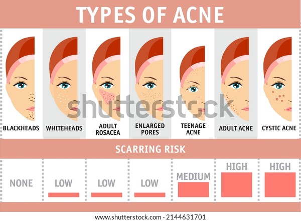 Vektor Stok Types Acne Infographics Vector Illustration Types (Tanpa ...