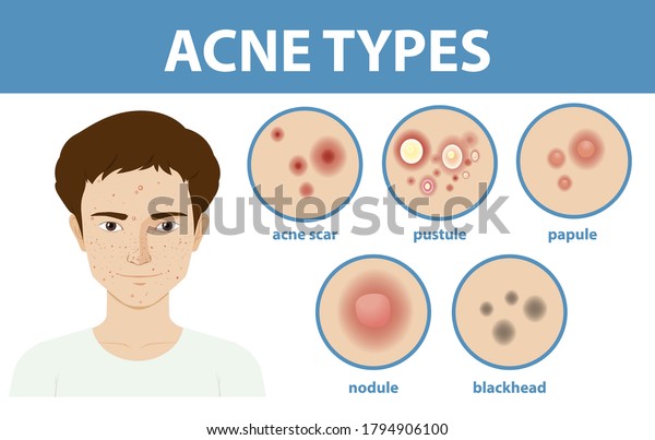 Types Acne On Skin Pimples Illustration Stock Vector (Royalty Free ...