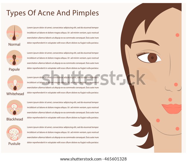 Types Acne Pimples Human Skin Poster 스톡 벡터(로열티 프리) 465601328 | Shutterstock
