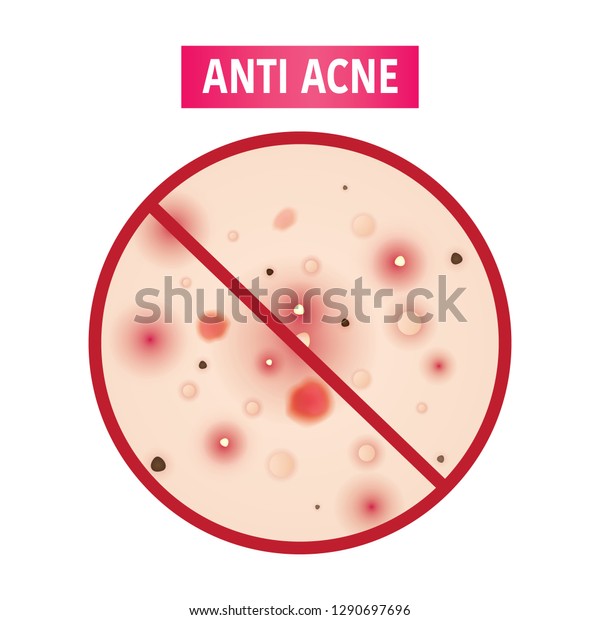Types Acne Vector Illustration Stock Vector (Royalty Free) 1290697696 ...