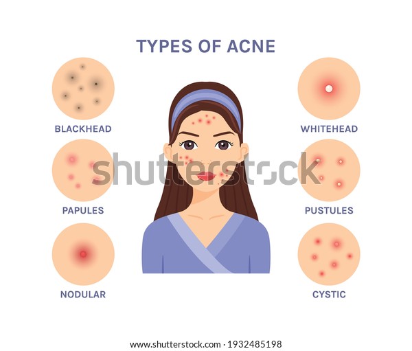 Types Acnepimples Isolated Cute Cartoon Brunette: vetor stock (livre de ...