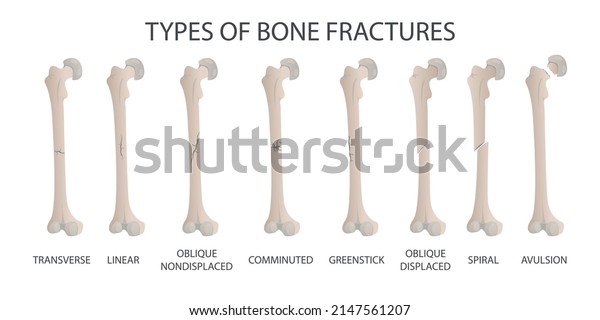 Types de fractures osseuses. Illustration montrant : image vectorielle ...