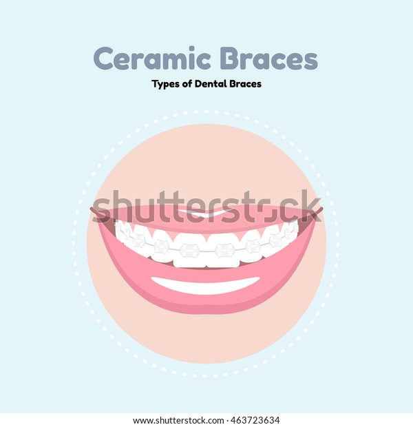 Types Dental Braces Vector Flat Illustration Stock Vector (Royalty Free ...