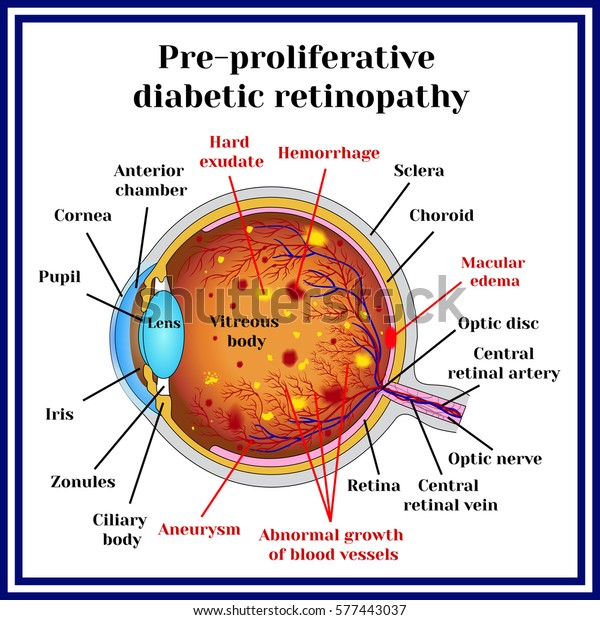 Types of diabetic retinopathy: pre-proliferative diabetic retinopathy