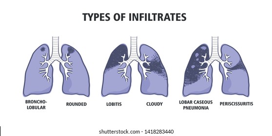 Types Infiltrates Pulmonary Tuberculosis Human Lungs: vetor stock ...