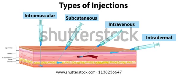 Types Injections Diagram Illustration Stock-vektor (royaltyfri ...