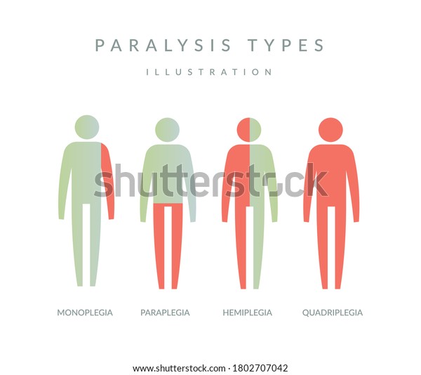 Types Paralysis Illustration Eps 10 File Stock Vector (Royalty Free ...