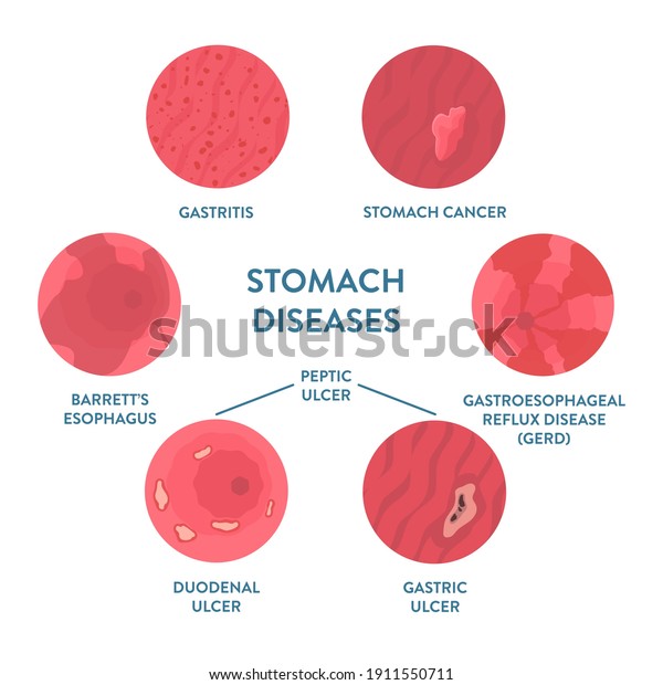 Types of stomach diseases detected by endoscopy diagnostics - gastritis ...