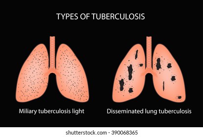 282 Types Tuberculosis Images, Stock Photos & Vectors | Shutterstock