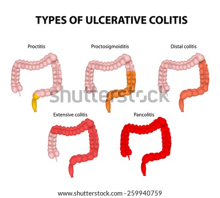 Types Ulcerative Colitis Diagram Shows Types Stock Vector (Royalty Free ...