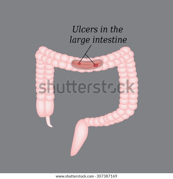 Ulcer Intestine Ulcers Colon Vector Illustration Stock Vector (Royalty ...