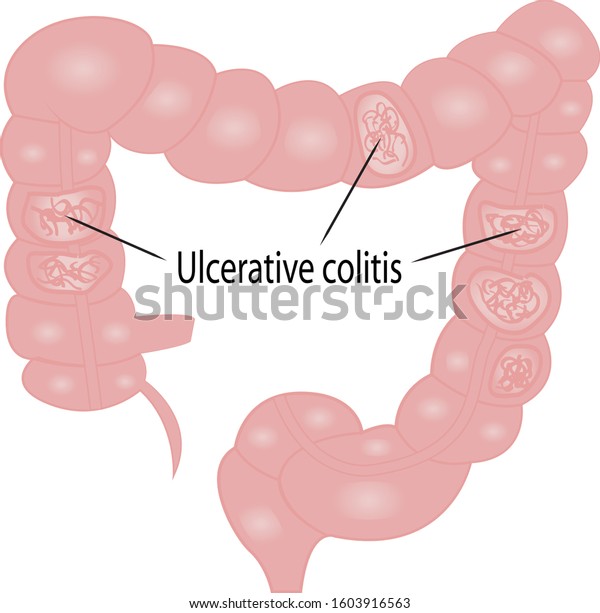 Vektor Stok Ulcerative Colitis Intestine Disease Vector Graphic (Tanpa ...