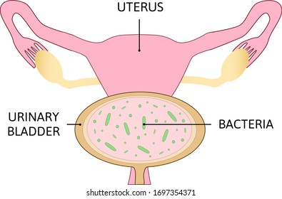 433 Cystitis infographic Images, Stock Photos & Vectors | Shutterstock