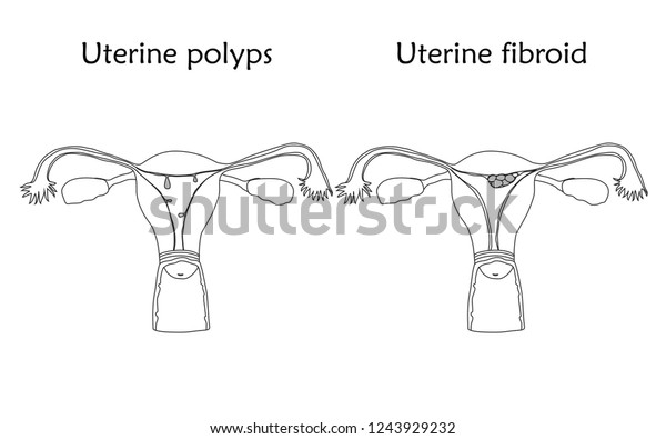 Uterine Polyps Uterine Fibroid Human Realistic 库存矢量图（免版税）1243929232 ...