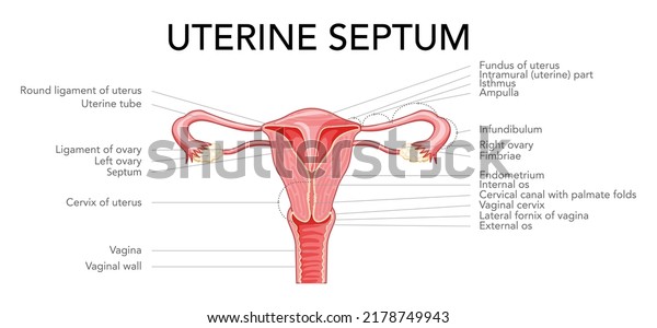 Vektor Stok Uterine Septum Septate Uterus Female Reproductive Tanpa