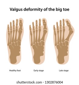 Foot Deformation Medical Desease Infographic Causes Stock Vector ...