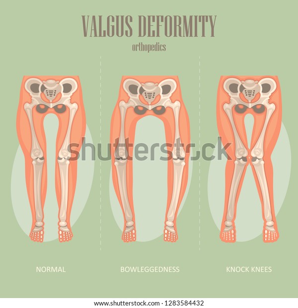Valgus Deformity Vector Medical Poster Stock Vector (Royalty Free ...