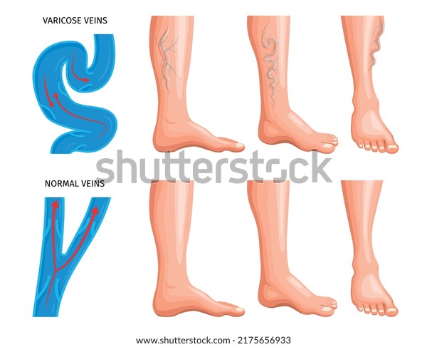 Varicose Veins Anatomy Realistic Set Magnifying: เวกเตอร์สต็อก (ปลอดค่า ...