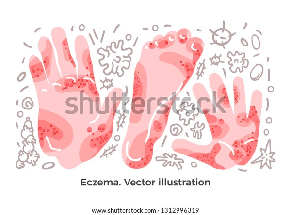 Vector Color Set Eczema Illness Symptom Stock Vector (Royalty Free ...