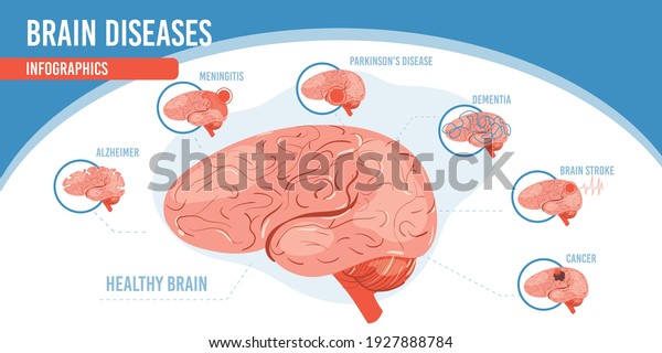 Vector Flat Cartoon Infographichealthy Brain List Stock Vector (Royalty ...
