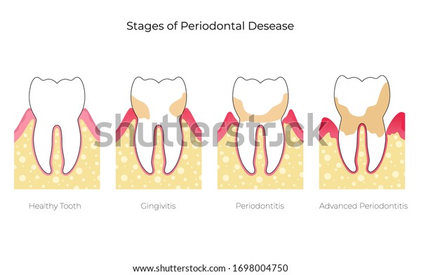 Vector Flat Isolated Illustration Periodontitis Tooth Stock Vector ...