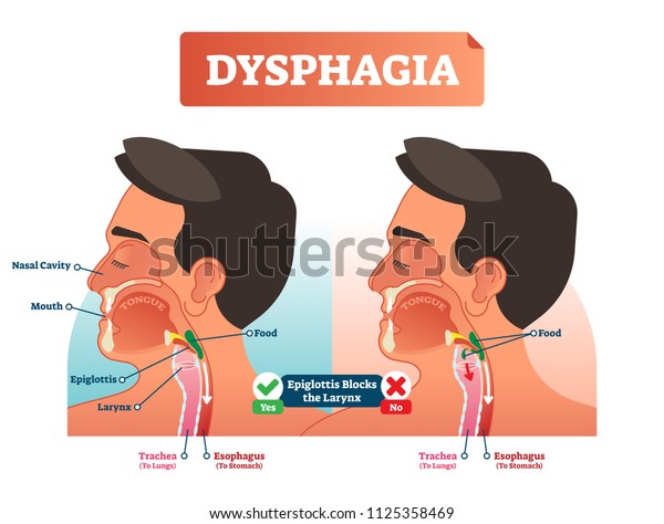 1 imagens de Anatomia esofago Imagens, fotos stock e vetores | Shutterstock