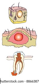 3,725 Skin abscess Images, Stock Photos & Vectors | Shutterstock