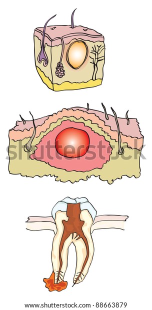 Vector Illustration Abscess Affected Parts Body Stock Vector (Royalty ...