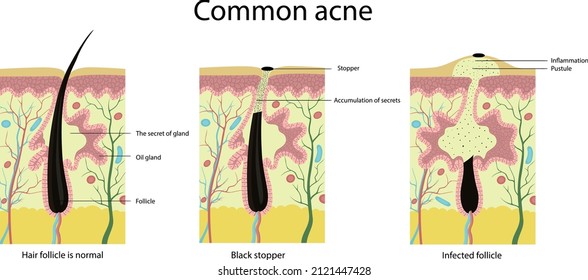 347 Acne formation Images, Stock Photos & Vectors | Shutterstock