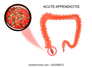 Vector Illustration Acute Appendicitis Bacteria Inflammation Stock ...