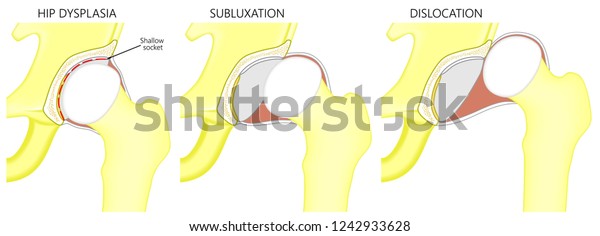 Vector Illustration Anatomy Hip Joint Dysplasia Stock Vector (Royalty ...